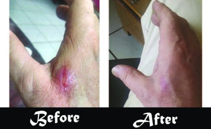 What is Morgellons Disease?